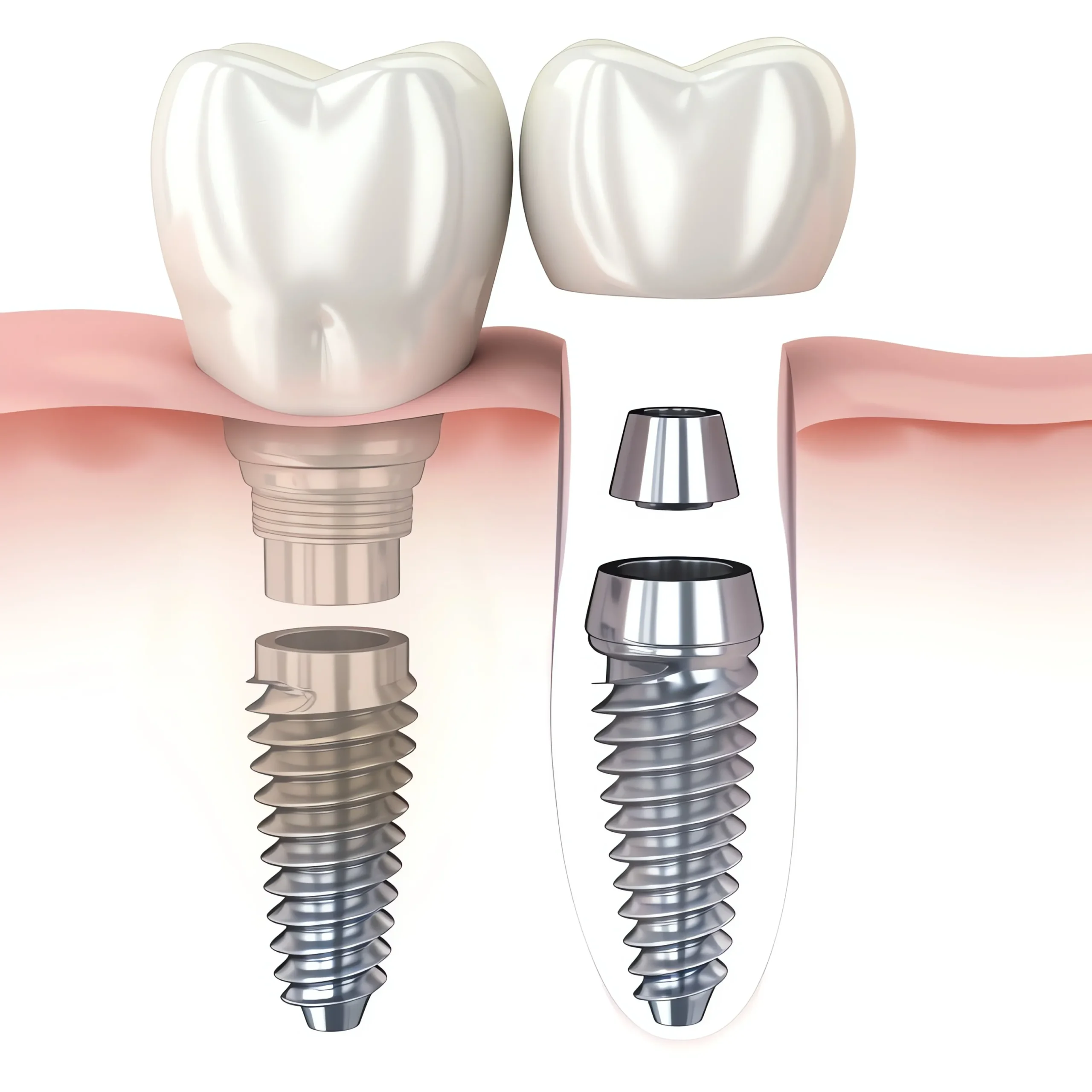 What Are Dental Implants? - Rose Medical