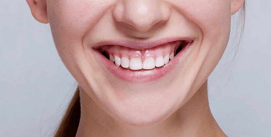 Traitement du Sourire Gingival : Causes et Options de Traitement - Rose ...