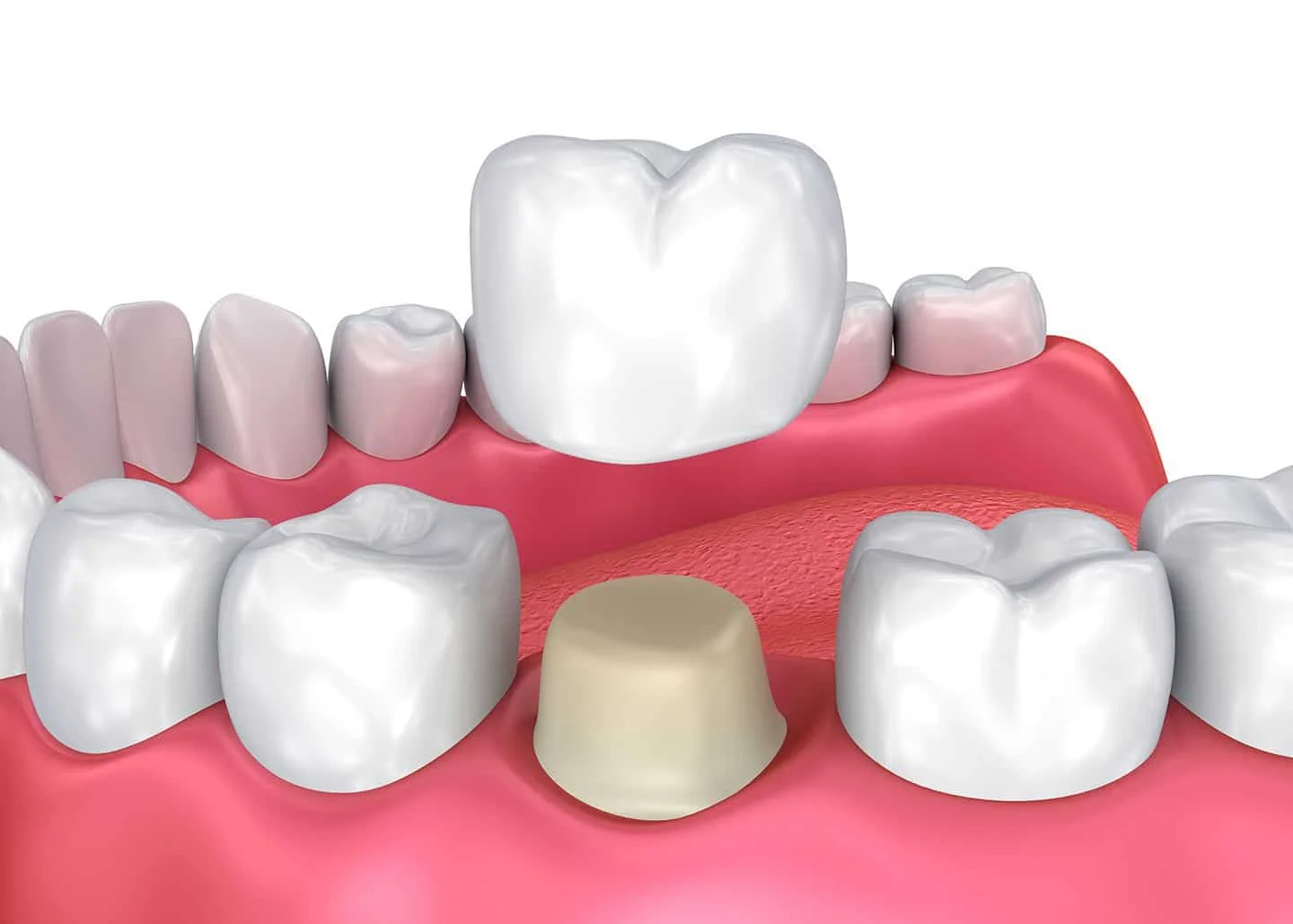 Tooth Crowns: Benefits, Types, and When You Need One - Rose Medical